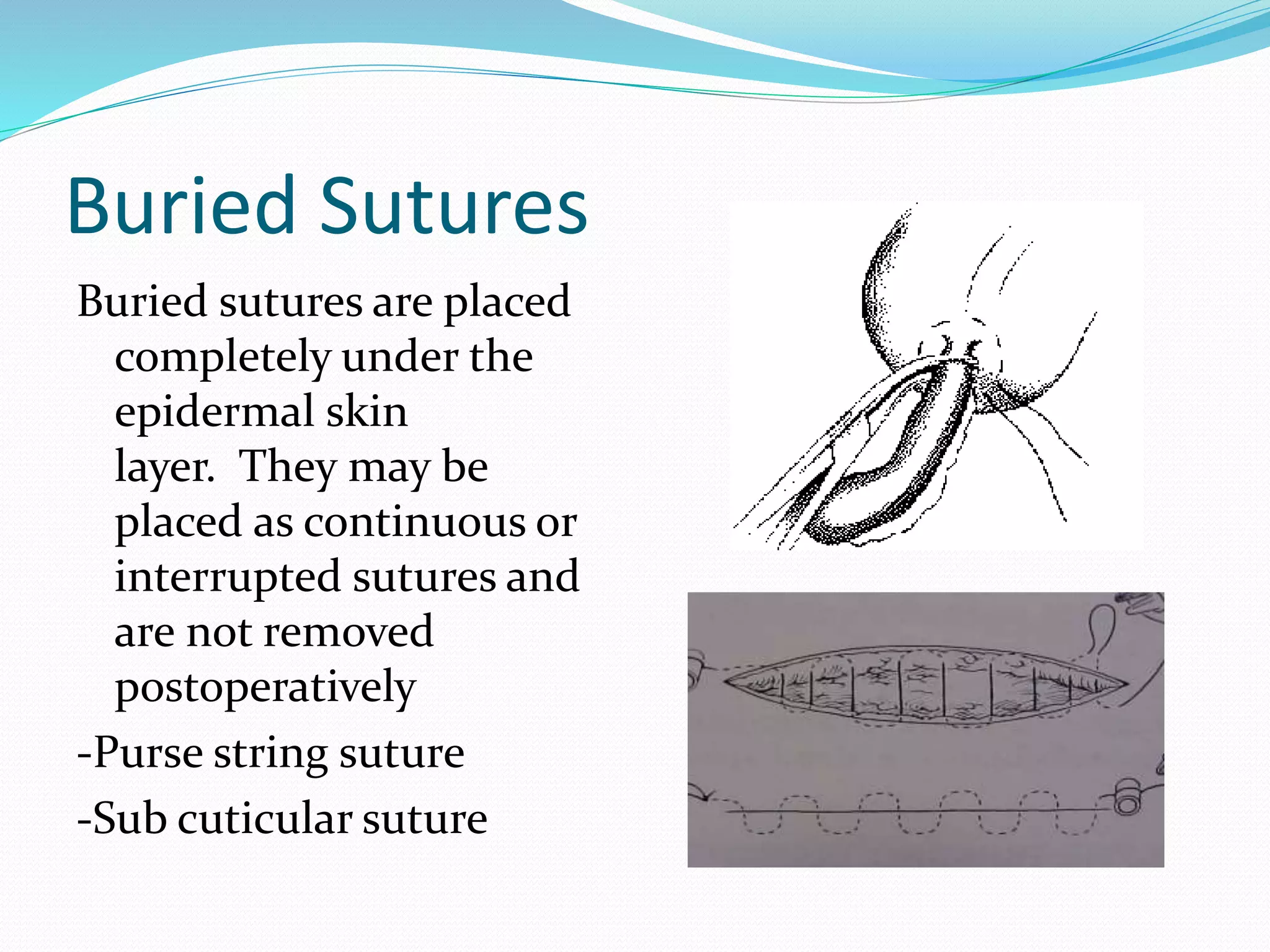 Principles of use and abuse of suture 1 | PPTX