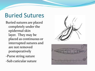 Principles of use and abuse of suture 1 | PPT