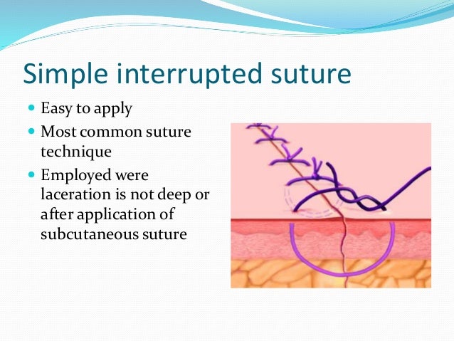 Principles of use and abuse of suture 1