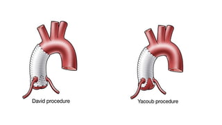 Principles of Valve Sparing Procedure [Autosaved].pptx