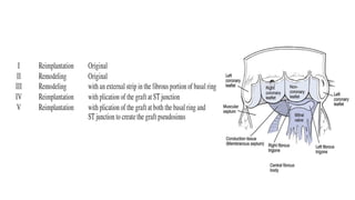 Principles of Valve Sparing Procedure [Autosaved].pptx