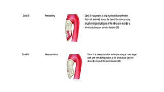 Principles of Valve Sparing Procedure [Autosaved].pptx