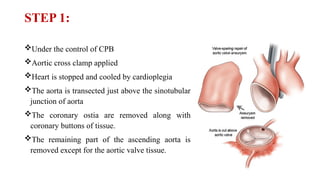 Principles of Valve Sparing Procedure [Autosaved].pptx