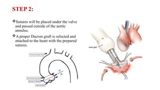Principles of Valve Sparing Procedure [Autosaved].pptx