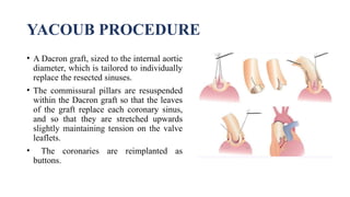 Principles of Valve Sparing Procedure [Autosaved].pptx