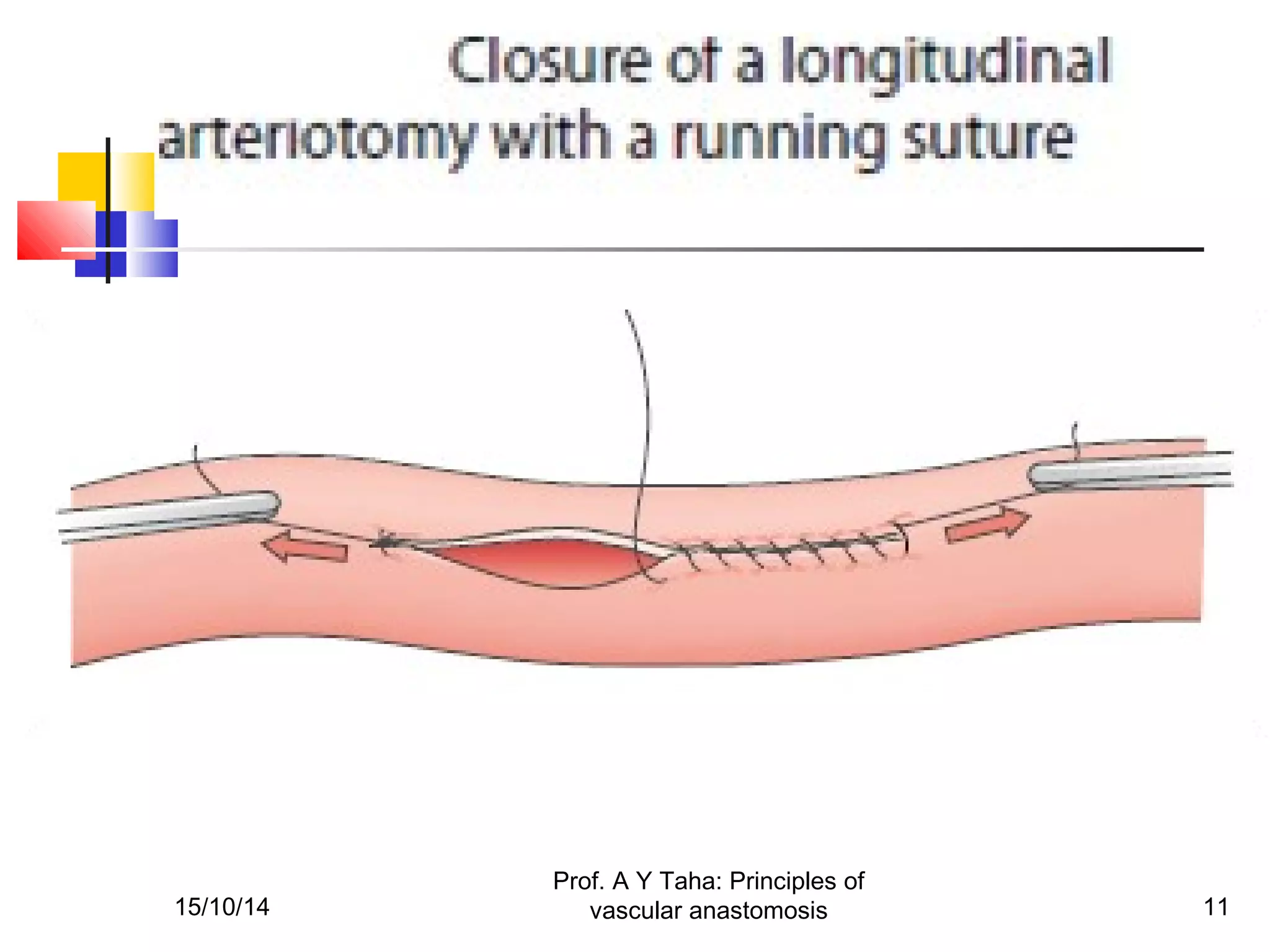 Principles of vascular anastomosis | PPT