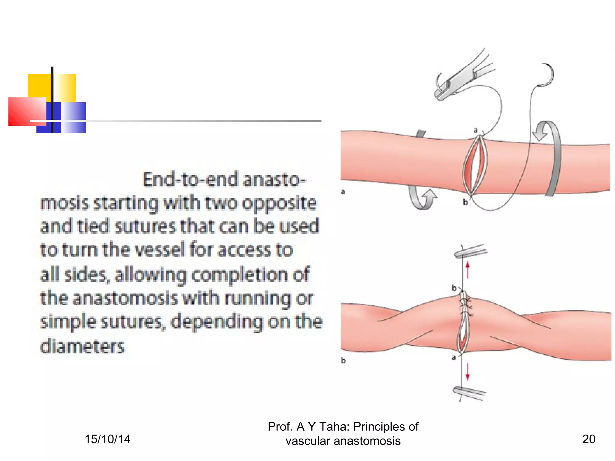 Principles of vascular anastomosis | PPT