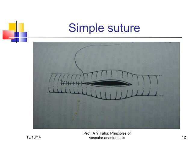 Principles of vascular anastomosis | PPT | First Aid | Injuries