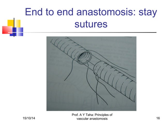 Principles of vascular anastomosis | PPT | First Aid | Injuries