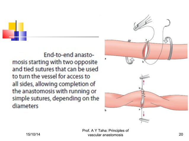 Principles of vascular anastomosis | PPT | First Aid | Injuries