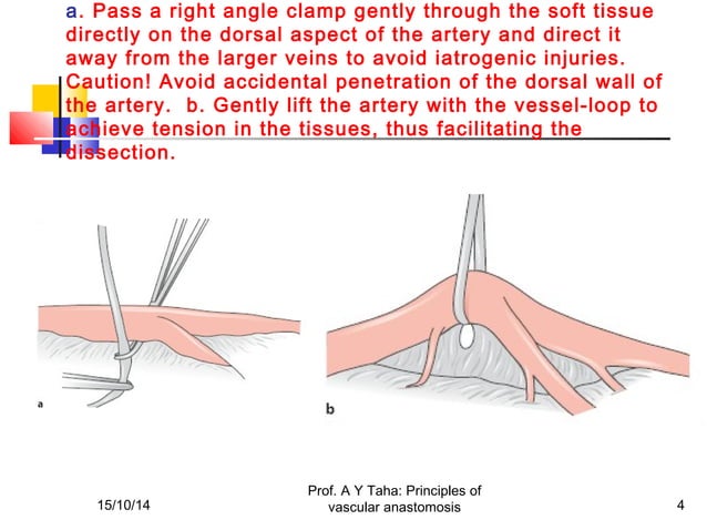 Principles of vascular anastomosis | PPT | First Aid | Injuries