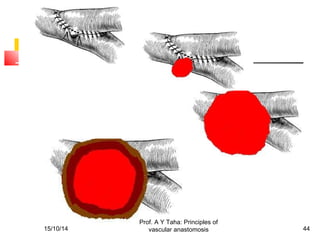 Principles of vascular anastomosis | PPT