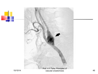 Principles of vascular anastomosis | PPT