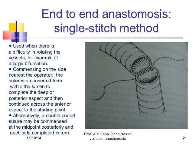 Principles of vascular anastomosis