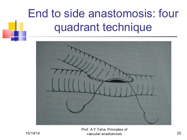 Principles of vascular anastomosis
