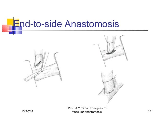 Principles of vascular anastomosis