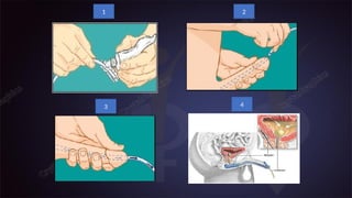 Teknik dan Prinsip Pemasangan Urine Catheter (Dower Chateter) | PPT
