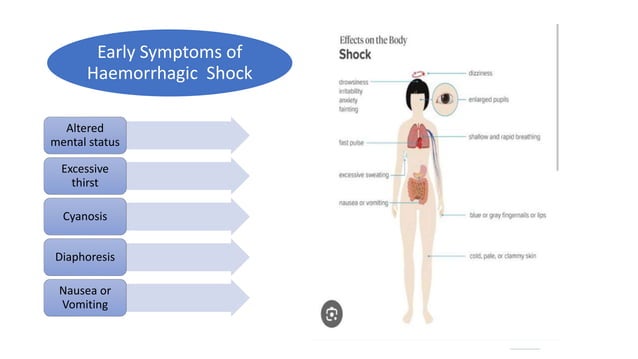 Haemorrhagic shock assessment management and colloid | PPT
