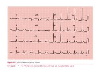 PR INTERVAL,CAUSES OF SHORT AND LONG PR INTERVAL | PPTX