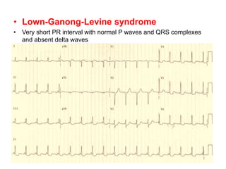 PR INTERVAL,CAUSES OF SHORT AND LONG PR INTERVAL | PPTX