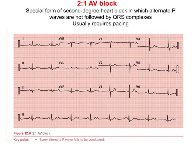 PR INTERVAL,CAUSES OF SHORT AND LONG PR INTERVAL | PPTX | Heart and ...