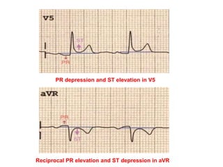 PR INTERVAL,CAUSES OF SHORT AND LONG PR INTERVAL | PPTX