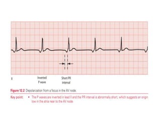 PR INTERVAL,CAUSES OF SHORT AND LONG PR INTERVAL | PPTX