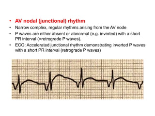 PR INTERVAL,CAUSES OF SHORT AND LONG PR INTERVAL | PPTX