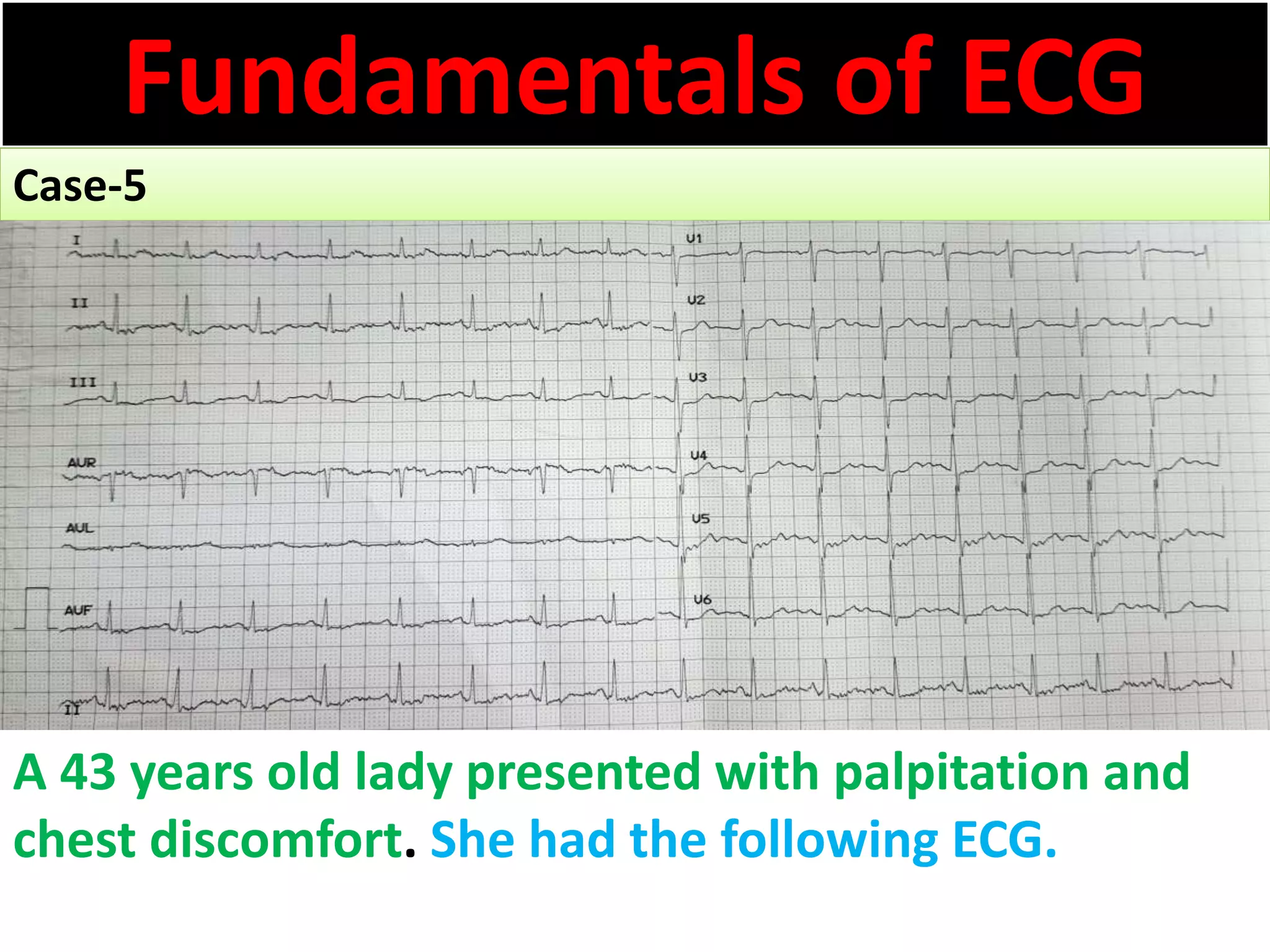 Approach to a patient with PR interval abnormality in ECG | PPSX