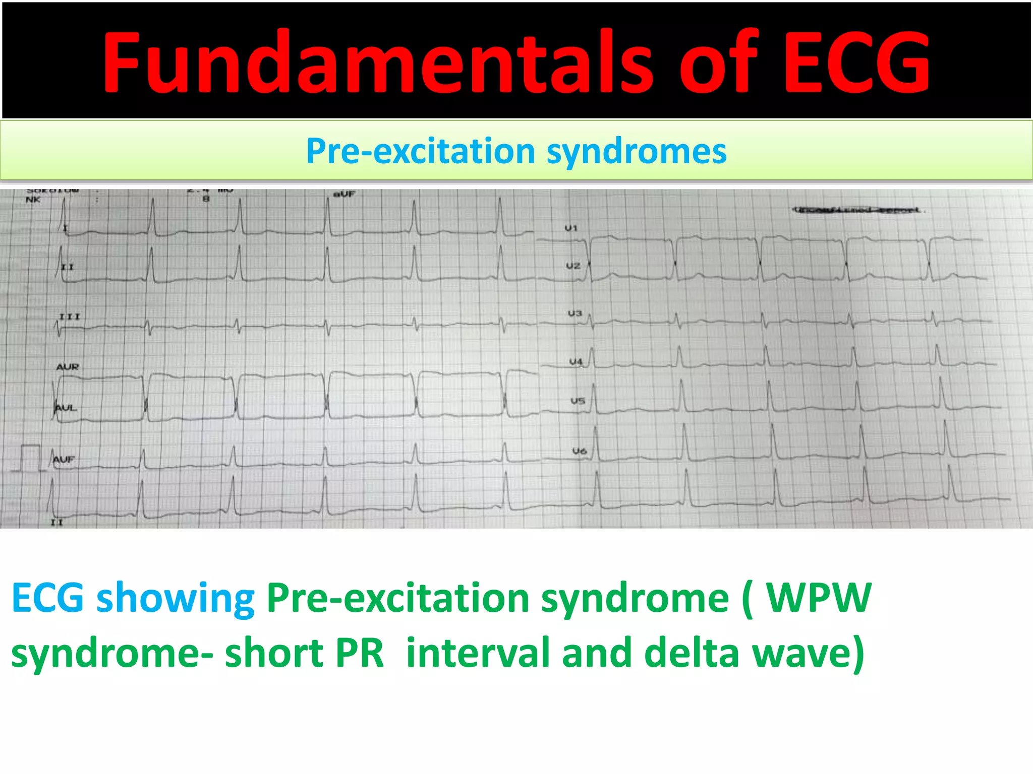 Approach to a patient with PR interval abnormality in ECG | PPSX