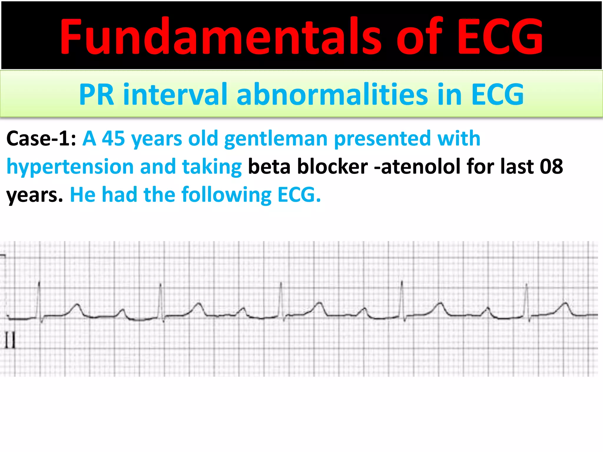 Approach to a patient with PR interval abnormality in ECG | PPSX