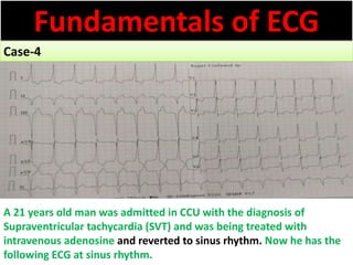 Approach to a patient with PR interval abnormality in ECG | PPSX