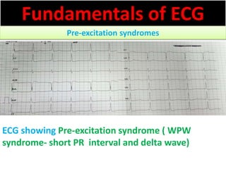 Approach to a patient with PR interval abnormality in ECG | PPSX