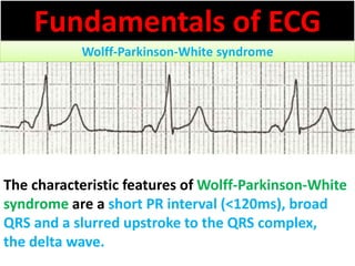 Prolonged Pr Interval
