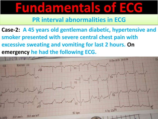 Approach to a patient with PR interval abnormality in ECG
