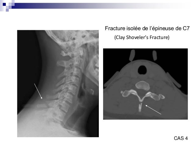 Prise en charge d’un traumatisme du rachis cervical 2015