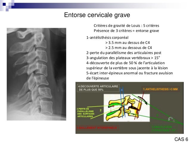Prise en charge d’un traumatisme du rachis cervical 2015