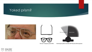 Prism for-diplopia cybersight | PDF