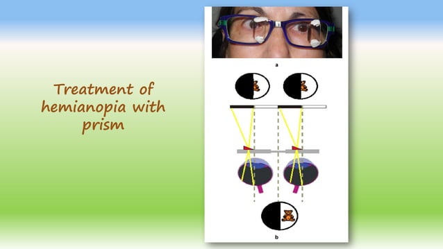 Optometry with Prism | PDF | Eye and Vision Conditions | Diseases and ...