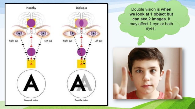 Optometry with Prism | PDF | Eye and Vision Conditions | Diseases and ...