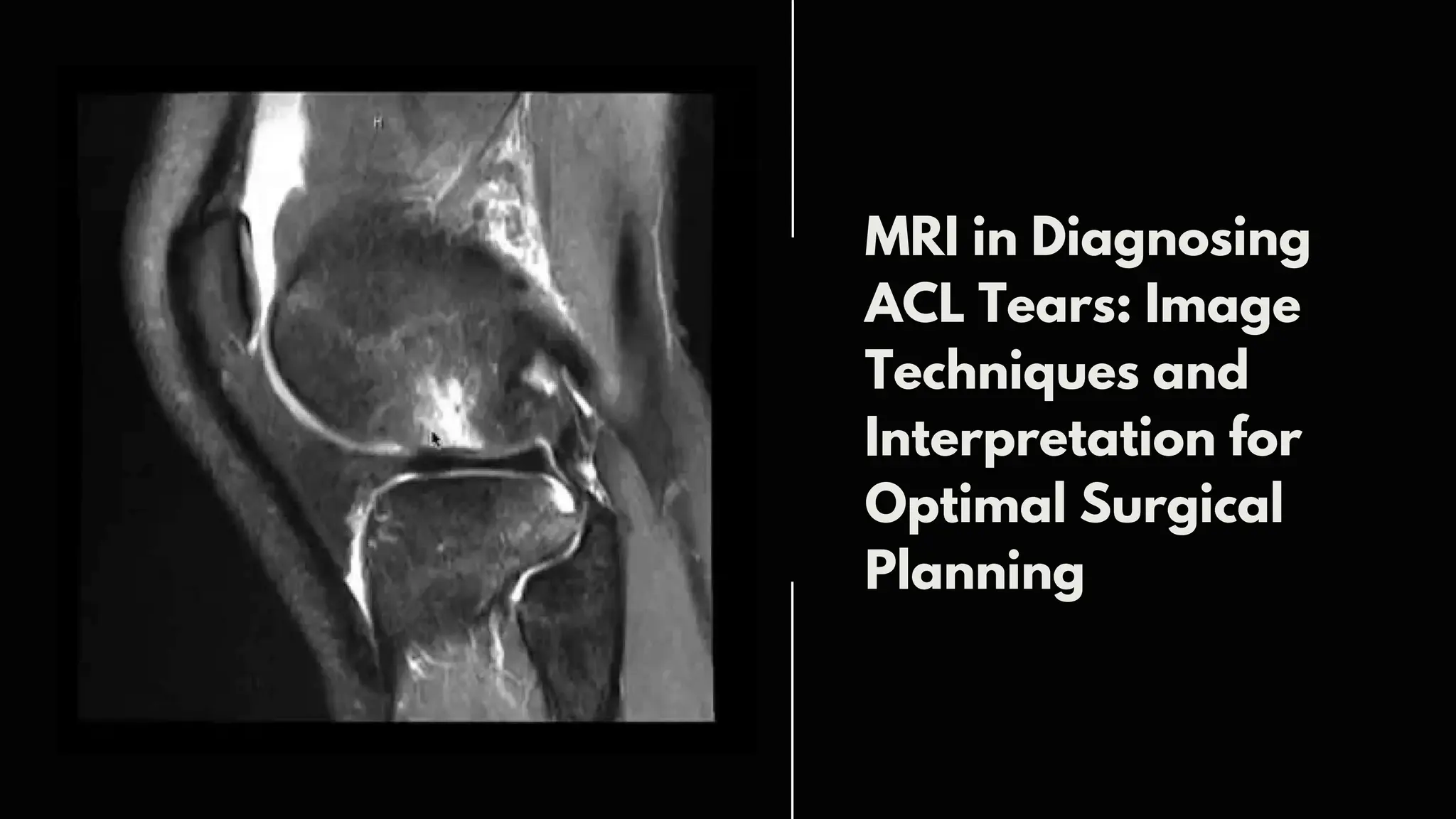 Pristyn Care - MRI in Diagnosing ACL Tears Image Techniques and ...