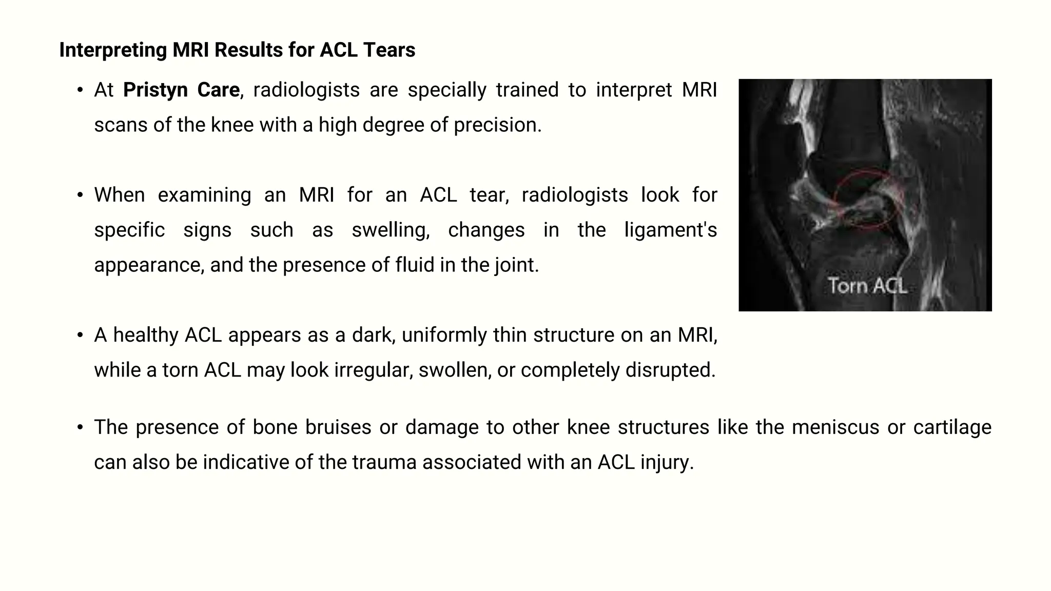 Pristyn Care - MRI in Diagnosing ACL Tears Image Techniques and ...