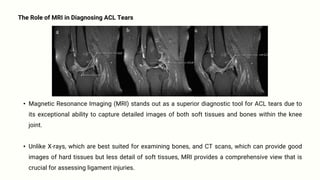 Pristyn Care - MRI in Diagnosing ACL Tears Image Techniques and ...