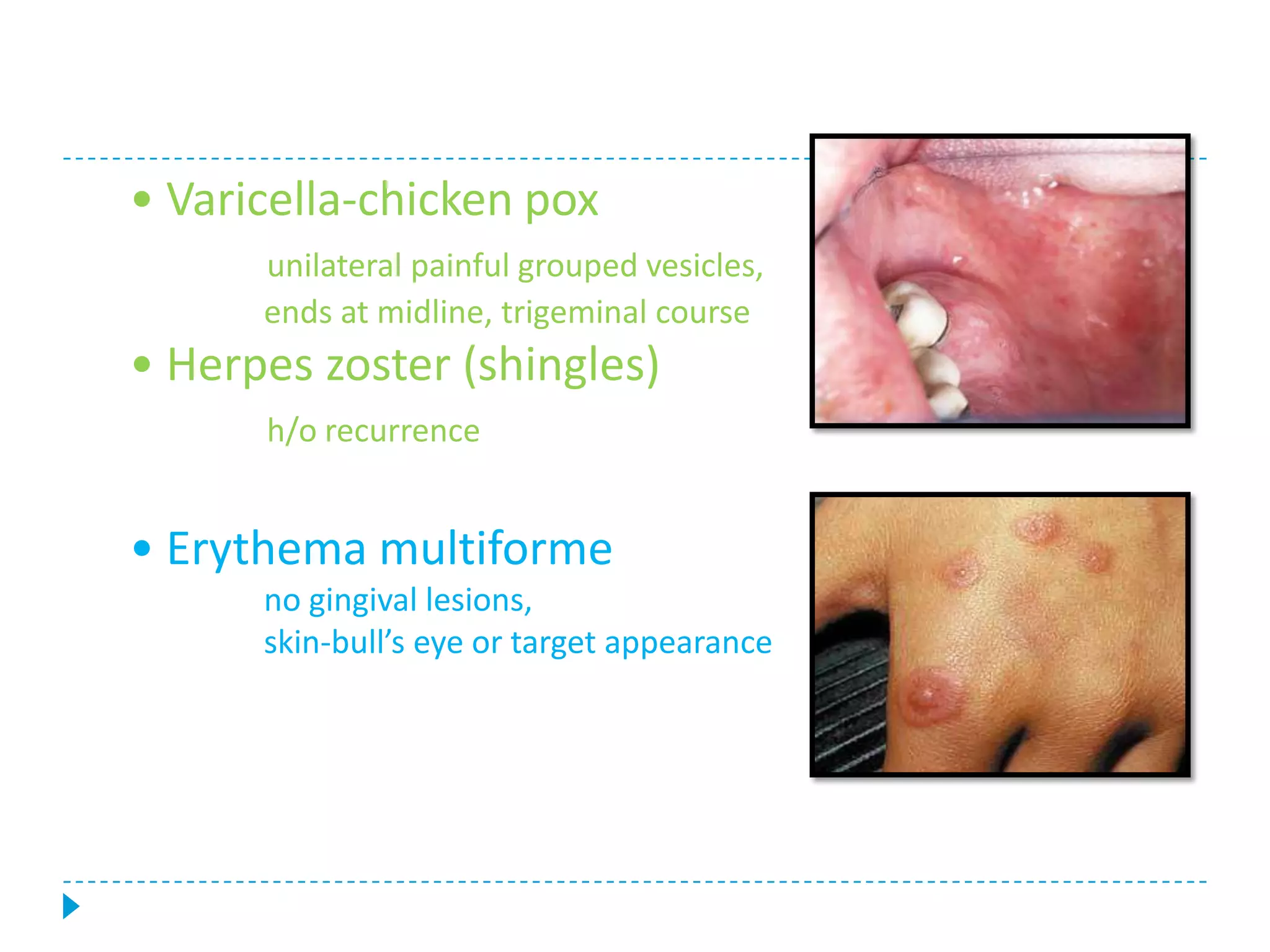 Priya seminar on ulcerative,vesicular and bullous lesions | PPTX