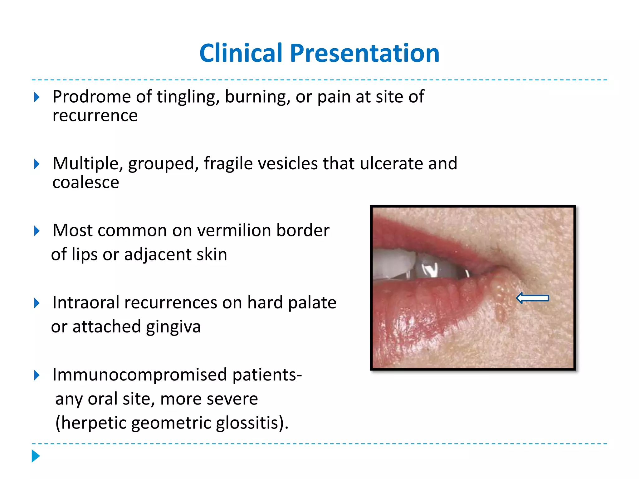 Priya seminar on ulcerative,vesicular and bullous lesions | PPTX