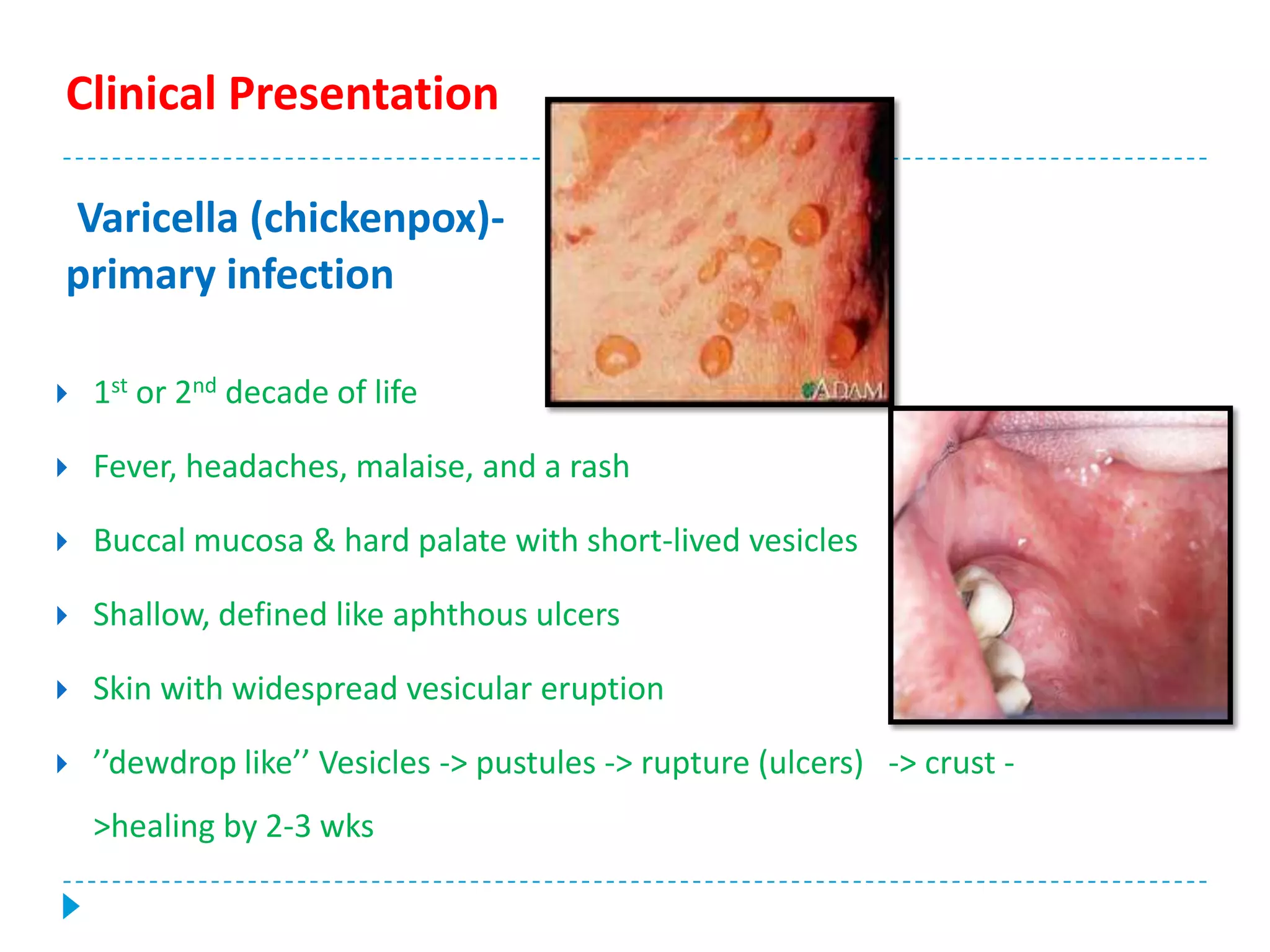 Priya seminar on ulcerative,vesicular and bullous lesions | PPTX