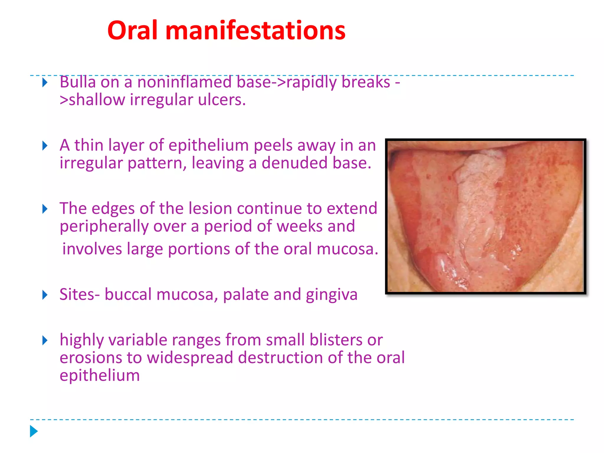 Priya seminar on ulcerative,vesicular and bullous lesions | PPTX