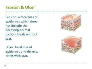 Priya seminar on ulcerative,vesicular and bullous lesions | PPTX