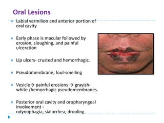 Priya seminar on ulcerative,vesicular and bullous lesions | PPTX