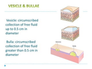 Vesicle Bulla
